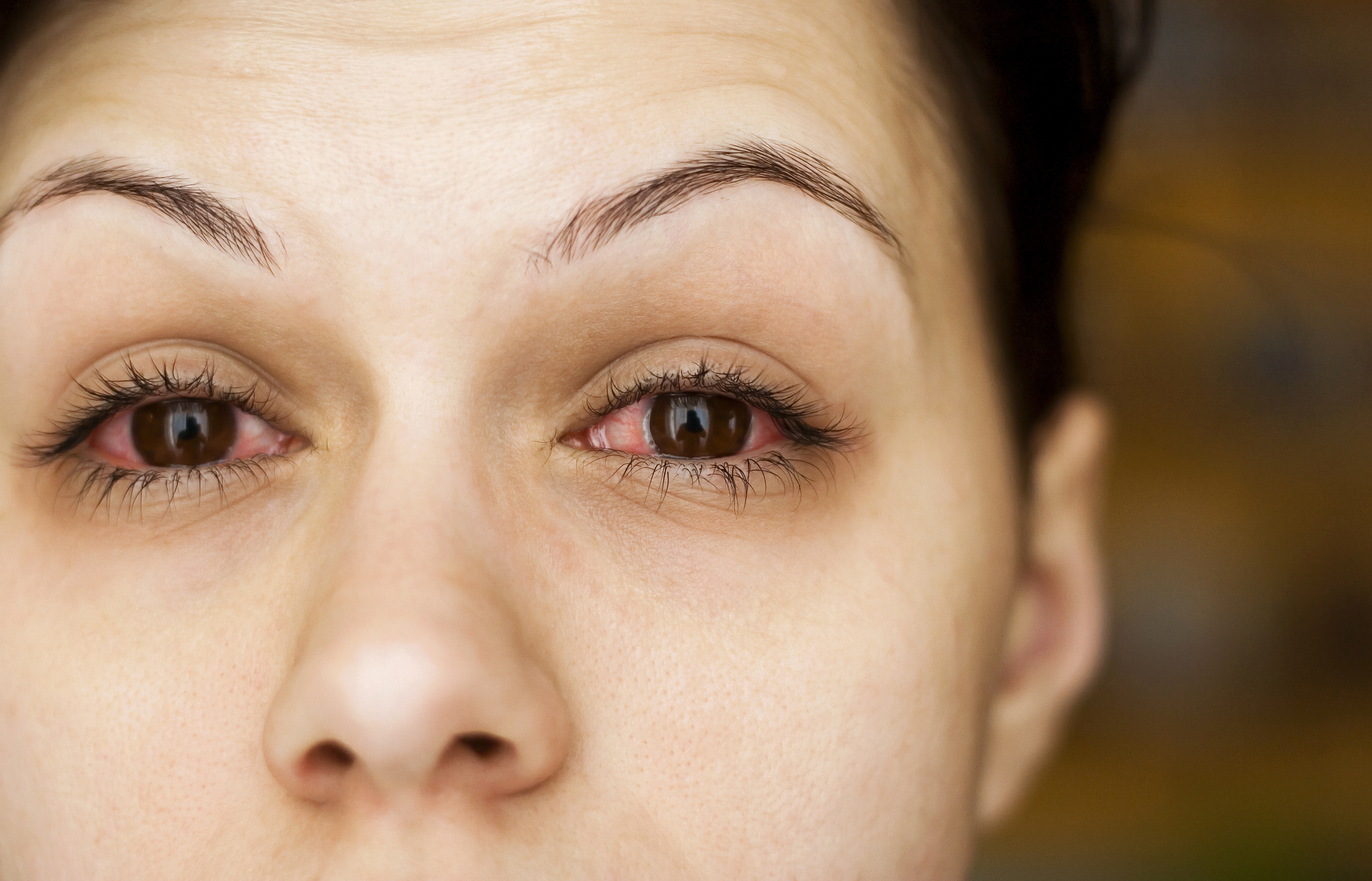 Sick woman's eyes - Instituto de Moléstias Oculares